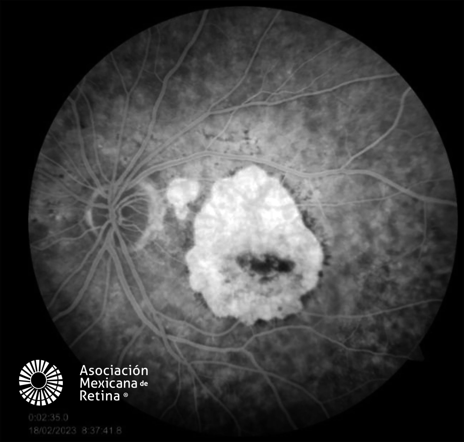 Imágenes Angiografía con Fluoresceína – AMR